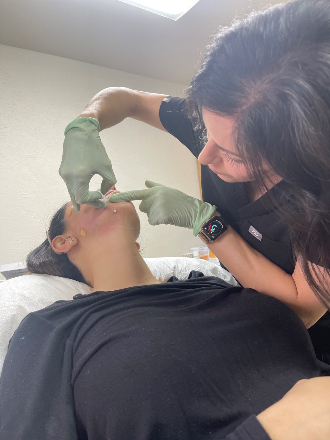 PDO Lifting Threads by V Soft Lift® | Optima Dermatology